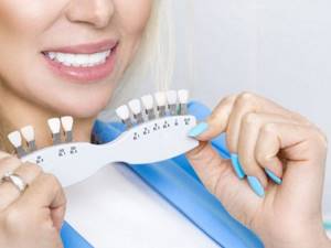 Люминиры на зубы: установка, виды, показания и противопоказания